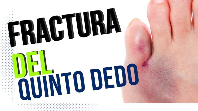 Cómo Hacer un Vendaje Efectivo para un Dedo Meñique del Pie Roto ...